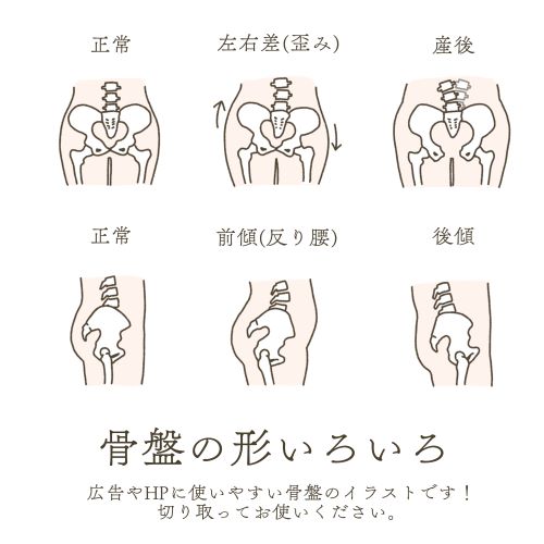 Types-of-pelvic-distortion | 東広島鍼灸整骨院